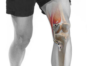 Lanzamiento en España del Sistema KineSpring de Moximed para el ...